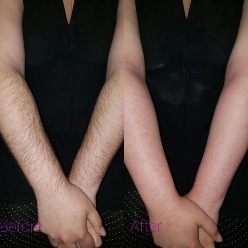 Do You Have Body or Arm Hair Problems? | Hera Hair Beauty